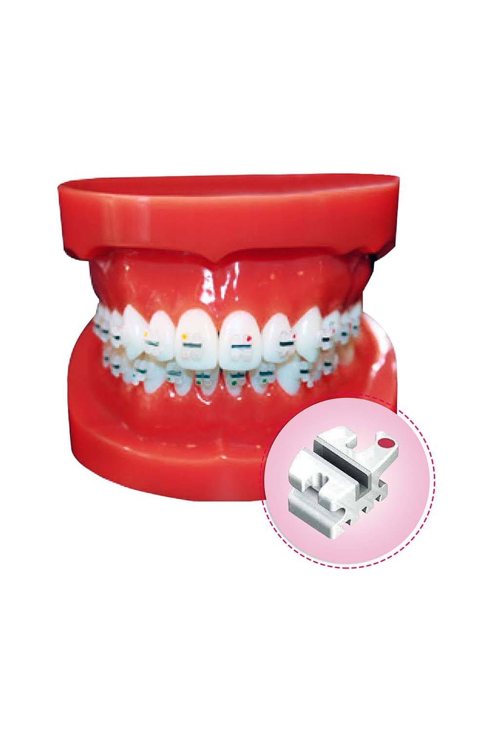 Tipodonto com brackets cerâmicos - Bionexum Dental Solutions