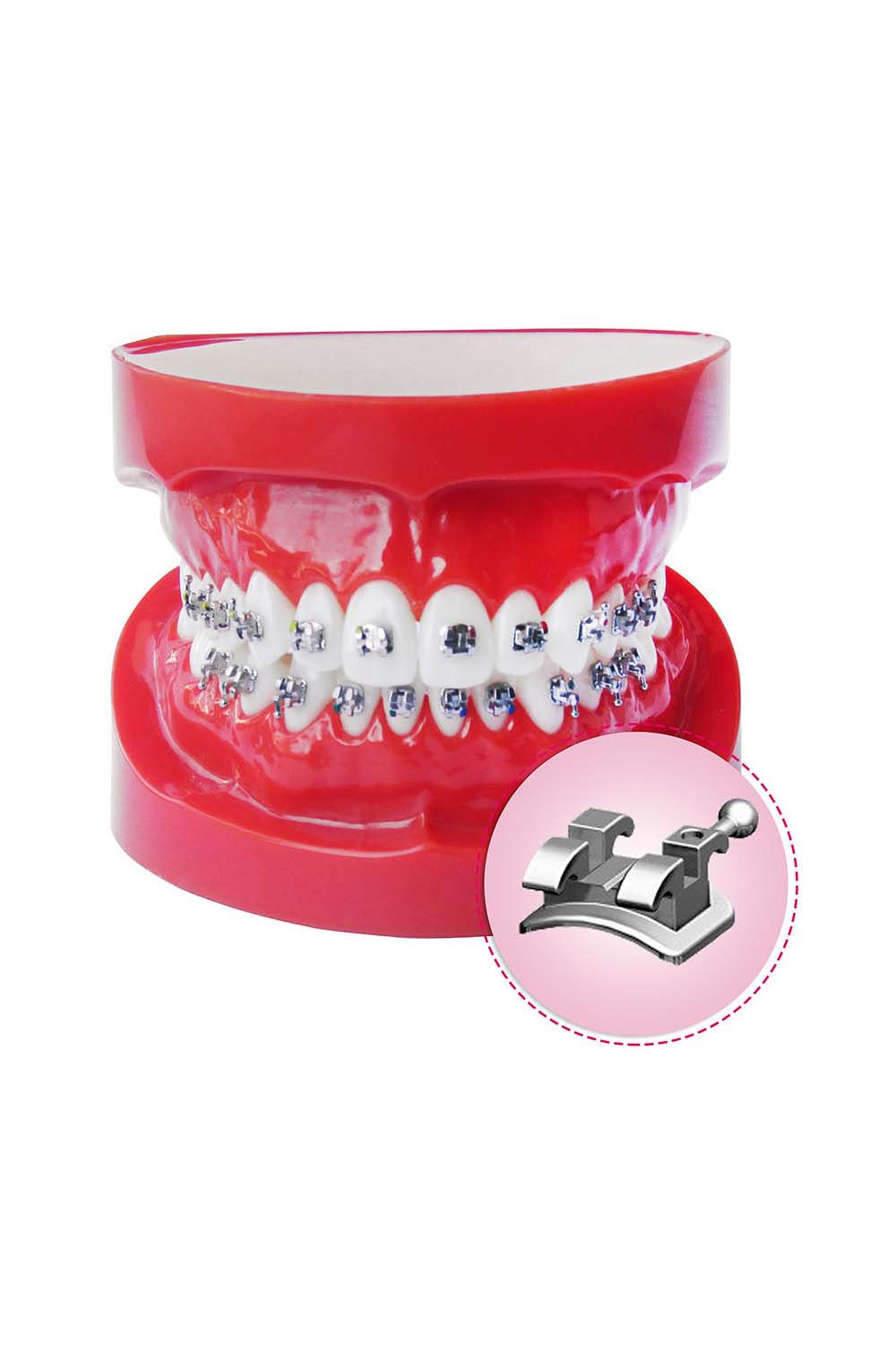 Tipodonto com brackets metálicos - Bionexum Dental Solutions